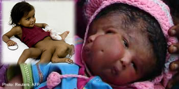 India's rare defect babies are revered not reviled