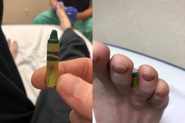 Crayon pierced between a father's toes is a warning for both parents ...
