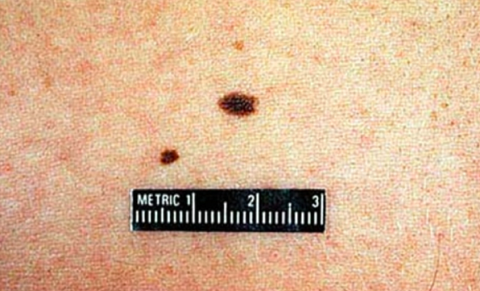 Here's what the dark spots on your face actually are and when you ...