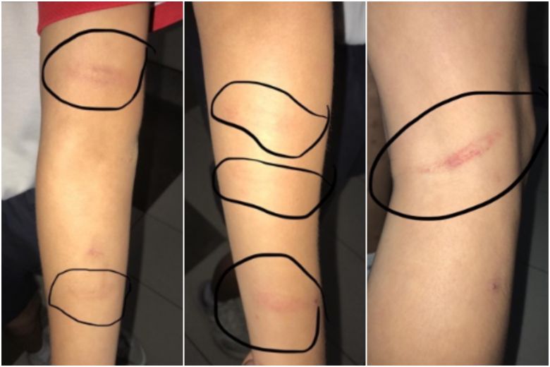 Mum files police report against school after finding welts on son ...