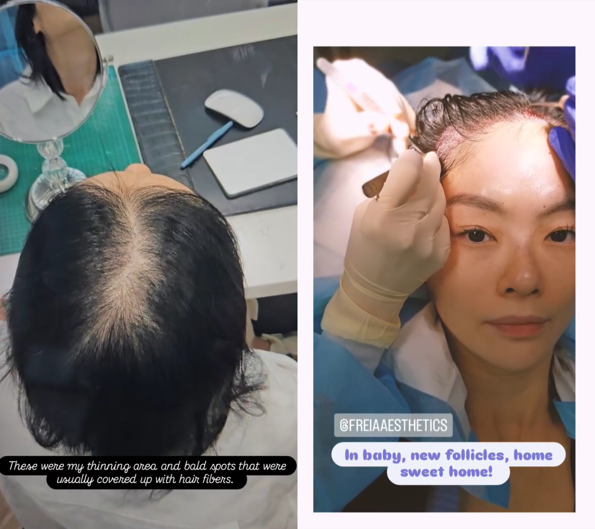 Sheila Sim shares photos of shaved head and hair transplant journey for ...