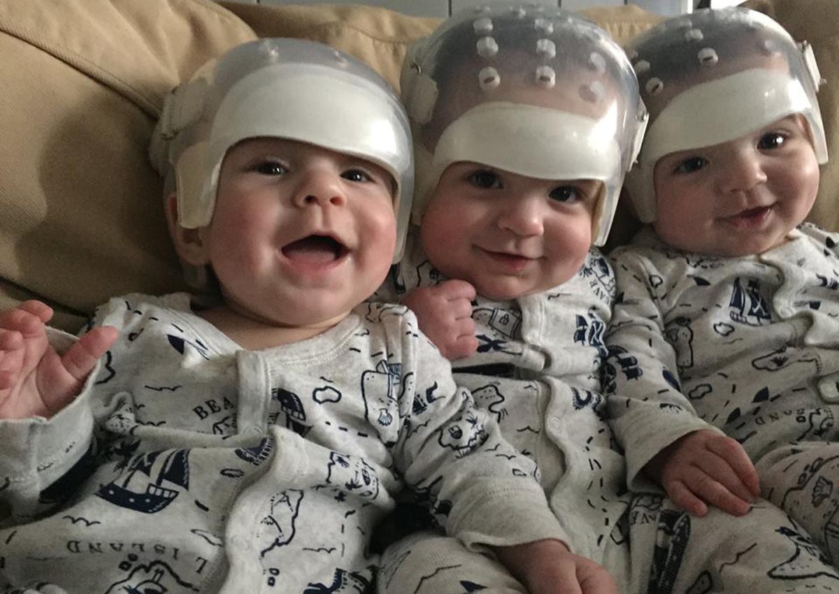 Adorable US triplets with skull deformity overcome rare birth defect ...