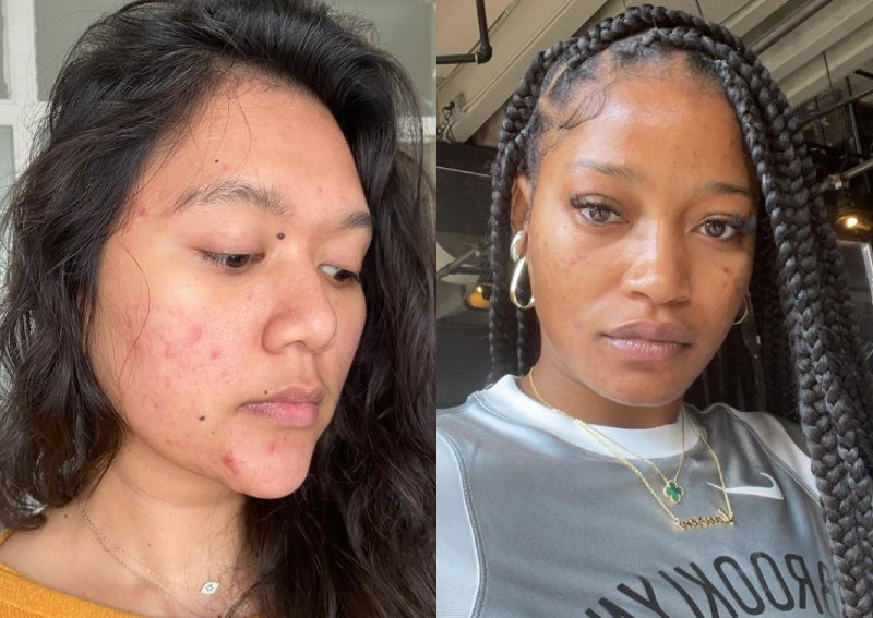 The skin-positive activists that are showing us it's ok to love your ...
