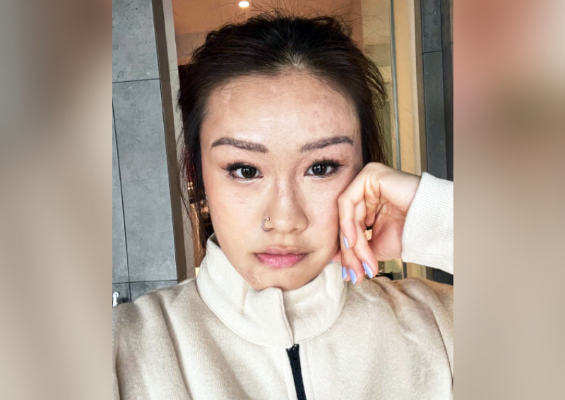 Inspirational Singaporean burns survivor Charlene Chew catches Khloe ...